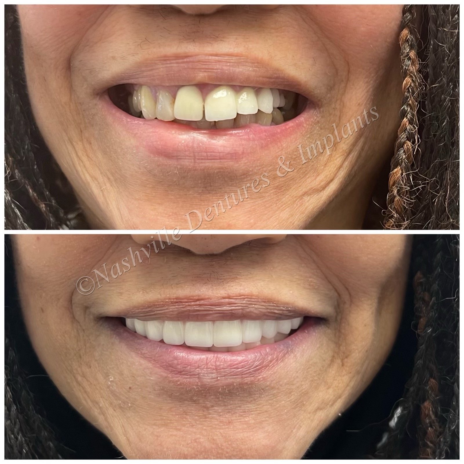 All-on-4 Teeth in a Day — NASHVILLE DENTURES AND IMPLANTS
