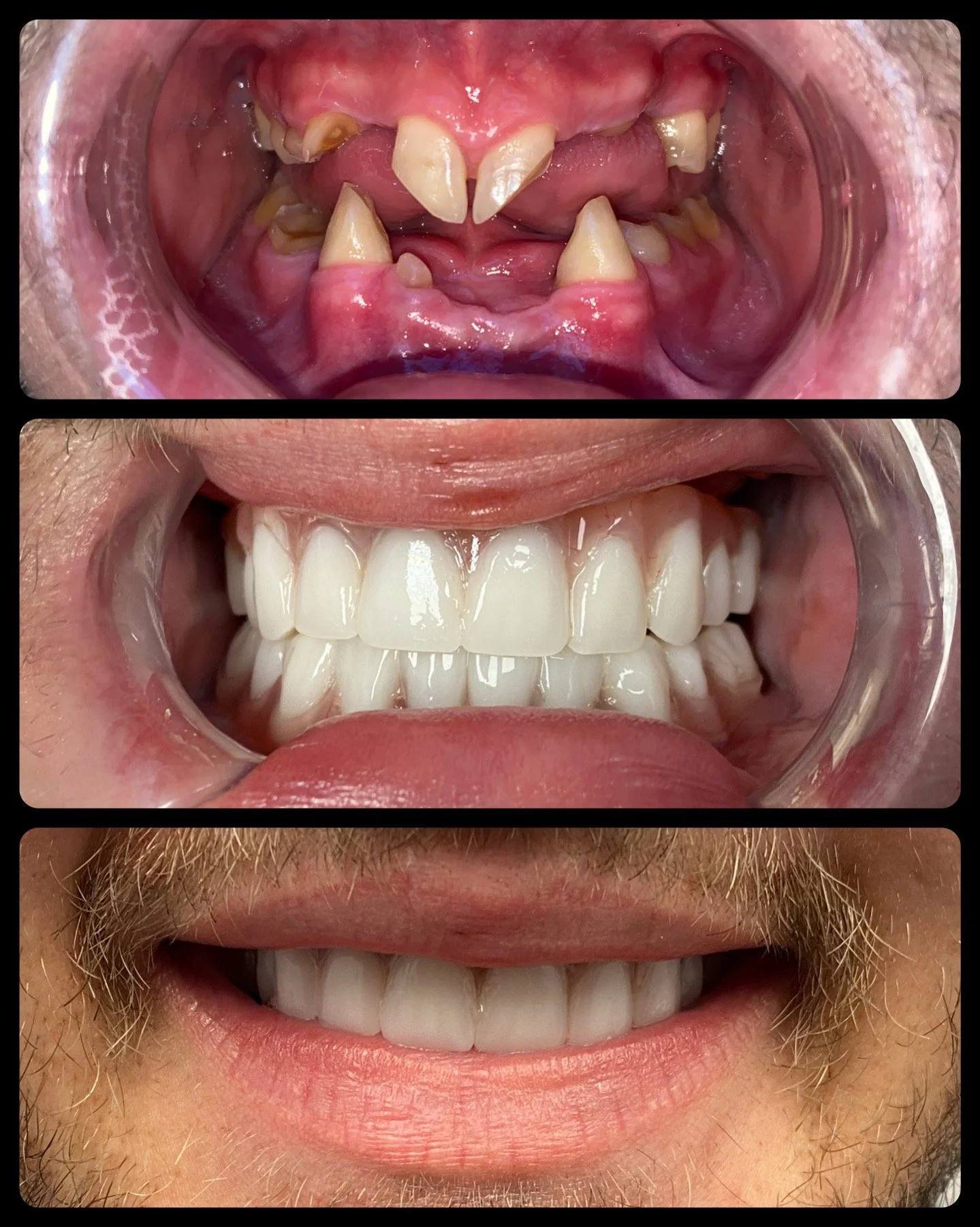 All-on-4 Teeth in a Day — NASHVILLE DENTURES AND IMPLANTS