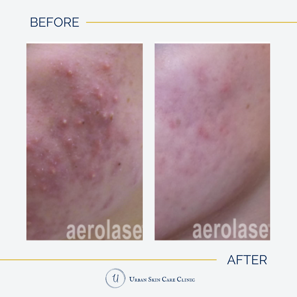 Aerolase Neo Elite Laser Treatment — Urban Skin Care Clinic