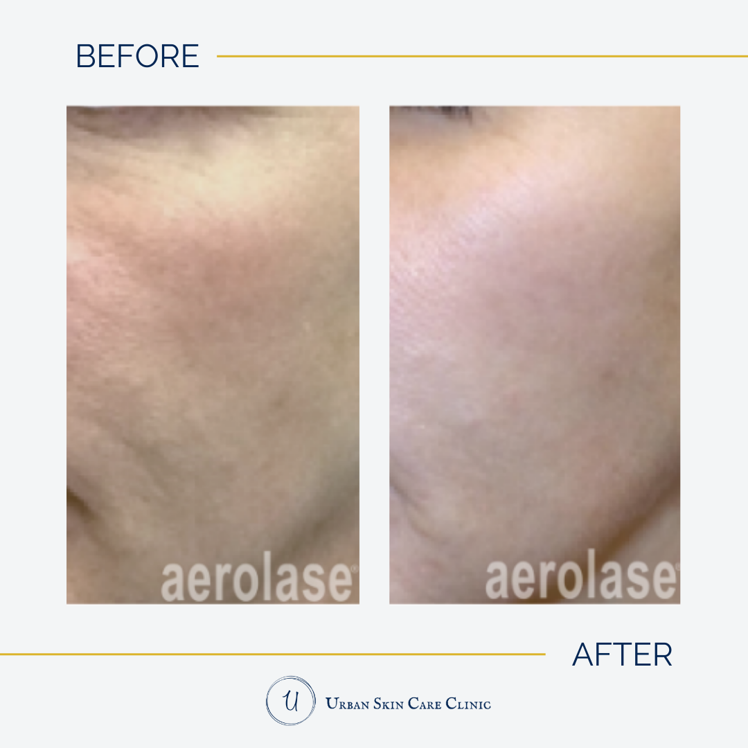 Aerolase Neo Elite Laser Treatment — Urban Skin Care Clinic
