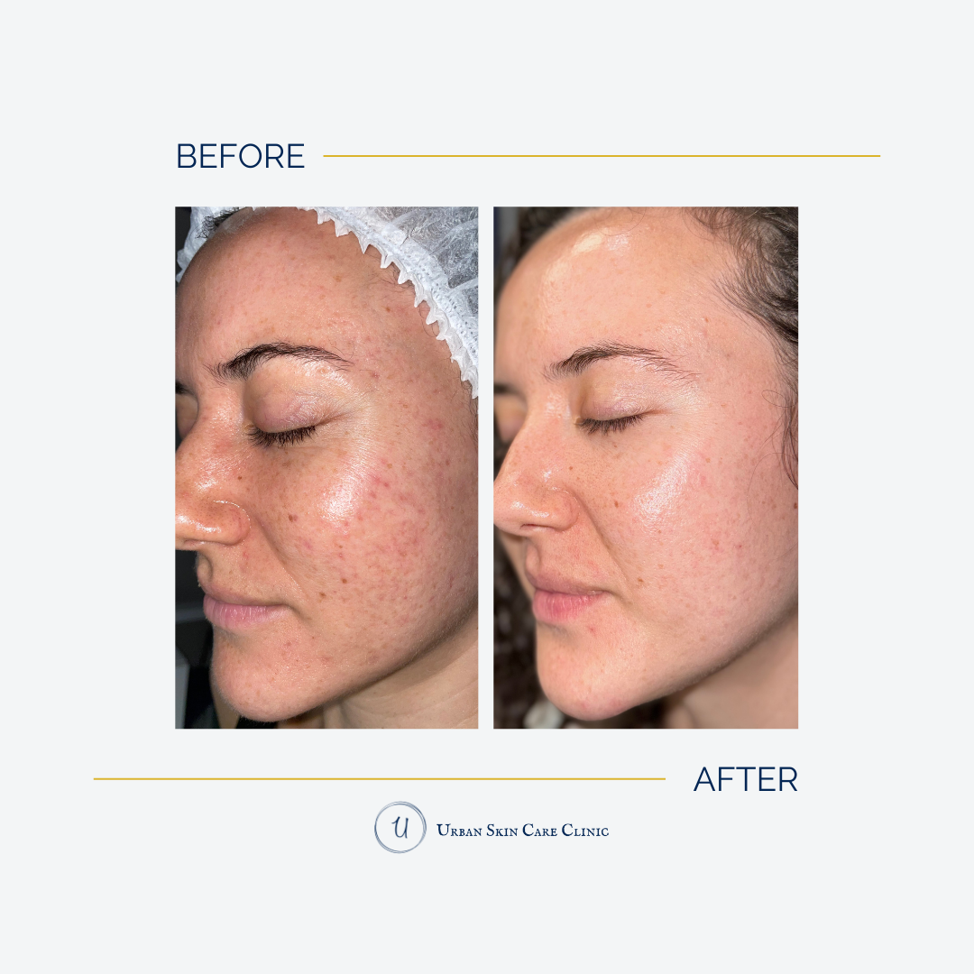 Aerolase Neo Elite Laser Treatment — Urban Skin Care Clinic