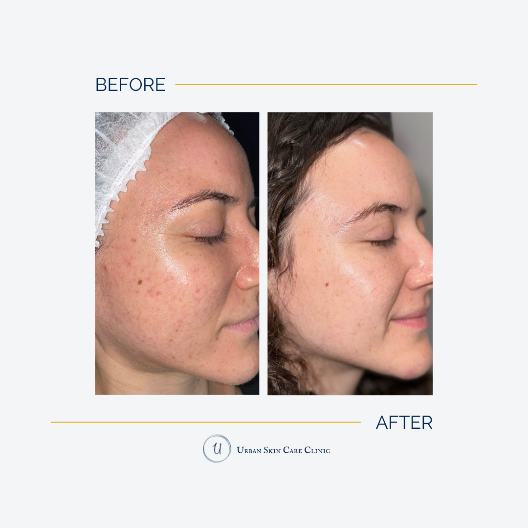 Aerolase Neo Elite Laser Treatment — Urban Skin Care Clinic