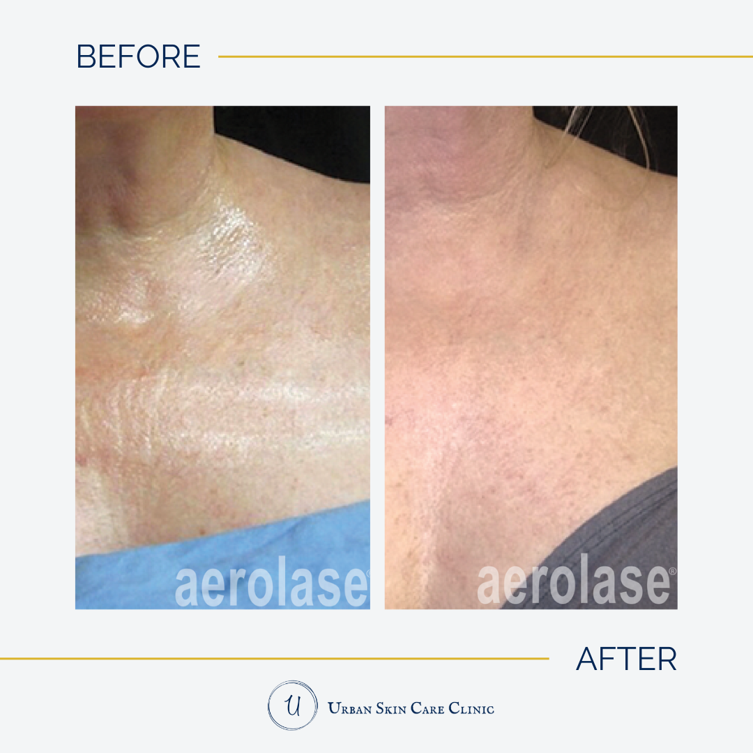 Aerolase Neo Elite Laser Treatment — Urban Skin Care Clinic
