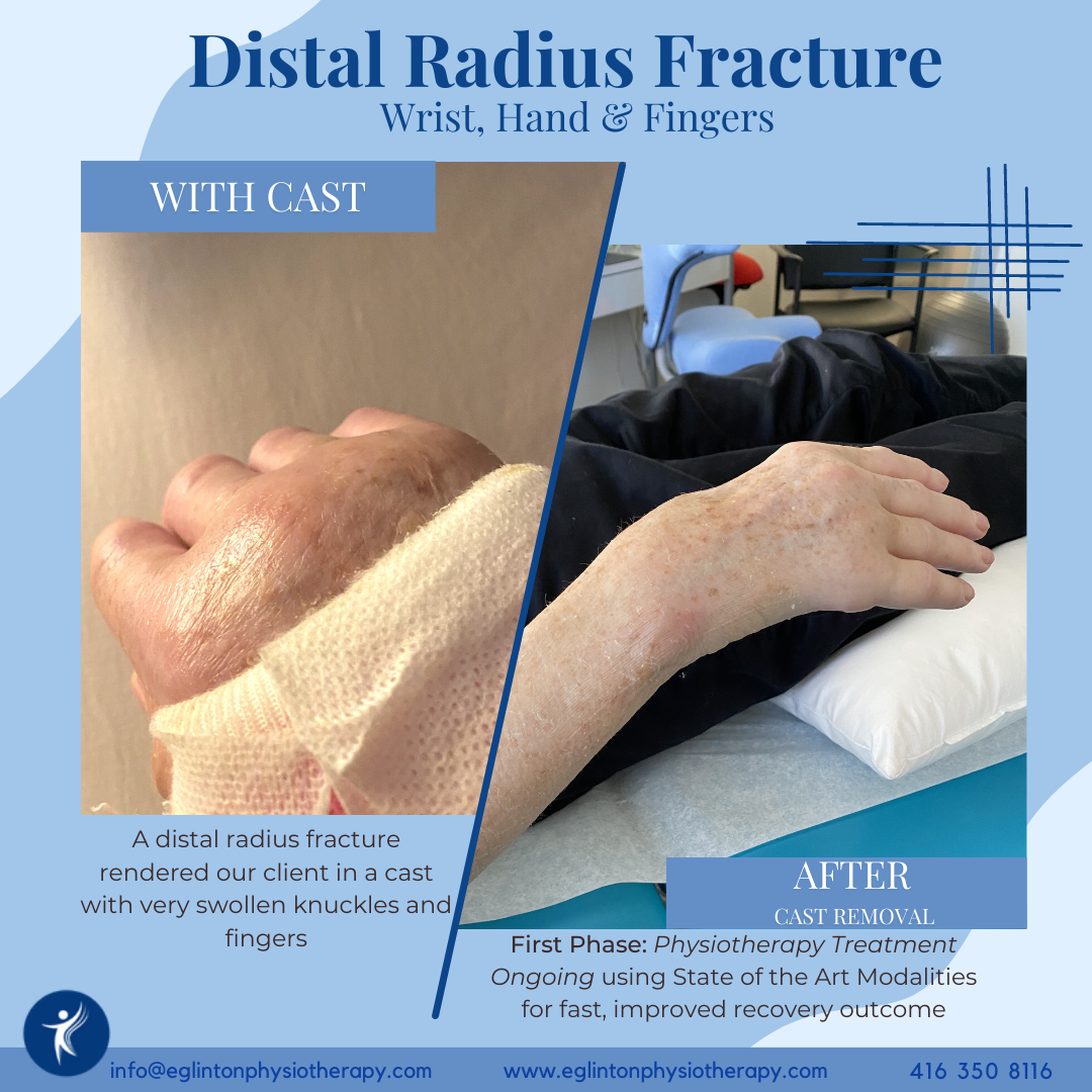Distal Radius Fracture — Eglinton Physiotherapy