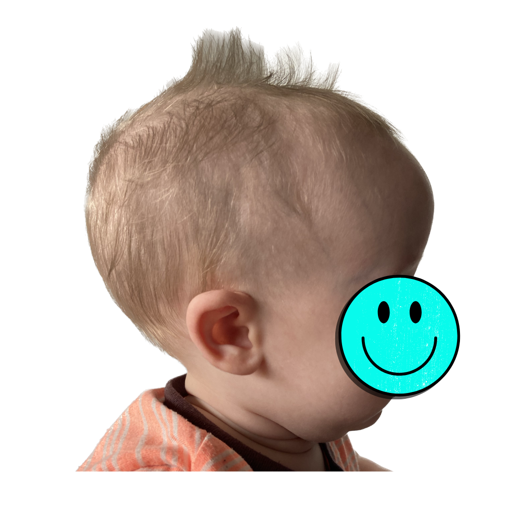 Head Shape 101: Different Kinds of Head Shapes and Cranial Deformity ...