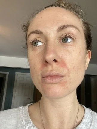 Perioral Dermatitis Forehead