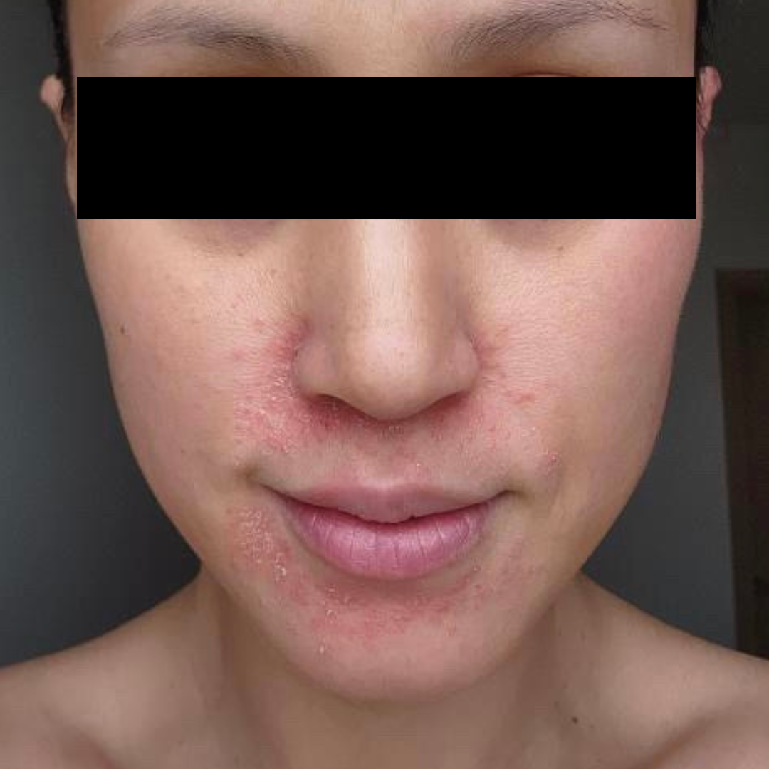 Perioral Dermatitis Online Courses — Well-Being In Bloom