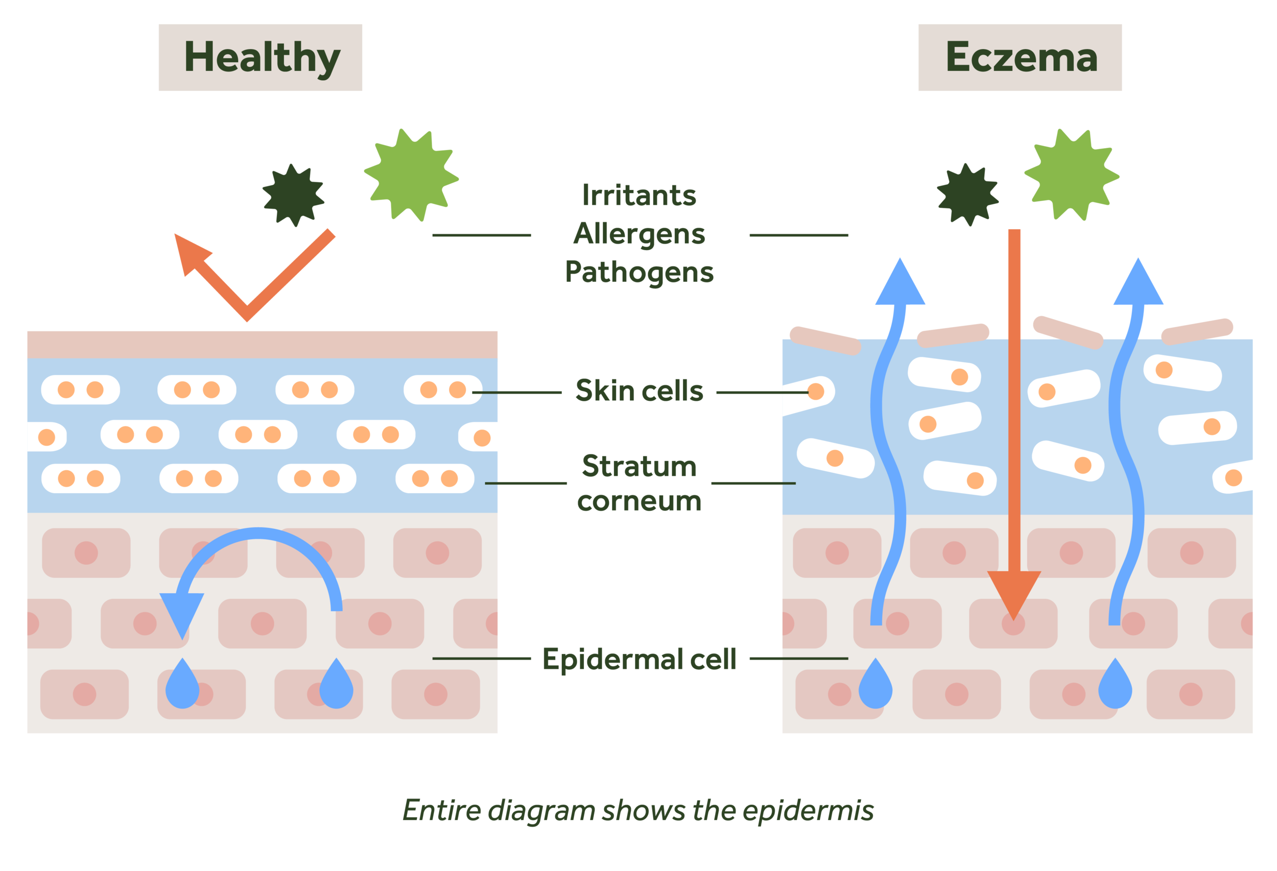 Eczema Relief - Spray-on Emollient for Eczema | Emollin® — Emollin