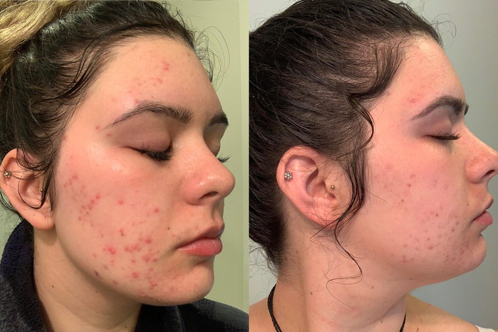 Dermapen — The Beauty Room