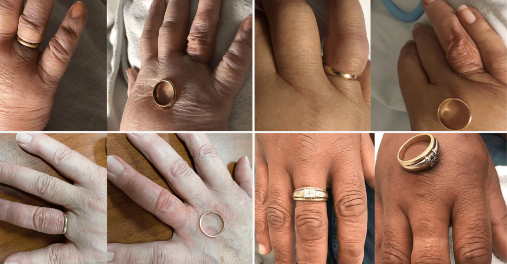 Ring Rescue Kit | Stuck Ring Removal Solution