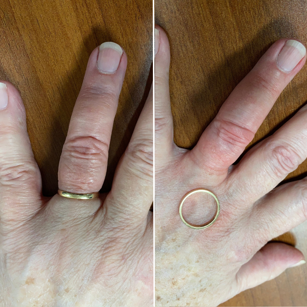 Ring Removal Without Cutting | Ring Rescue Compression Device™