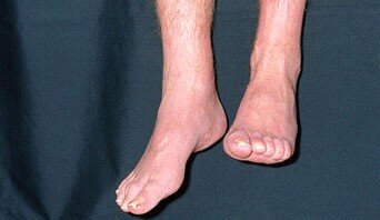 Do you have foot drop? — The Nerve Injury Clinic