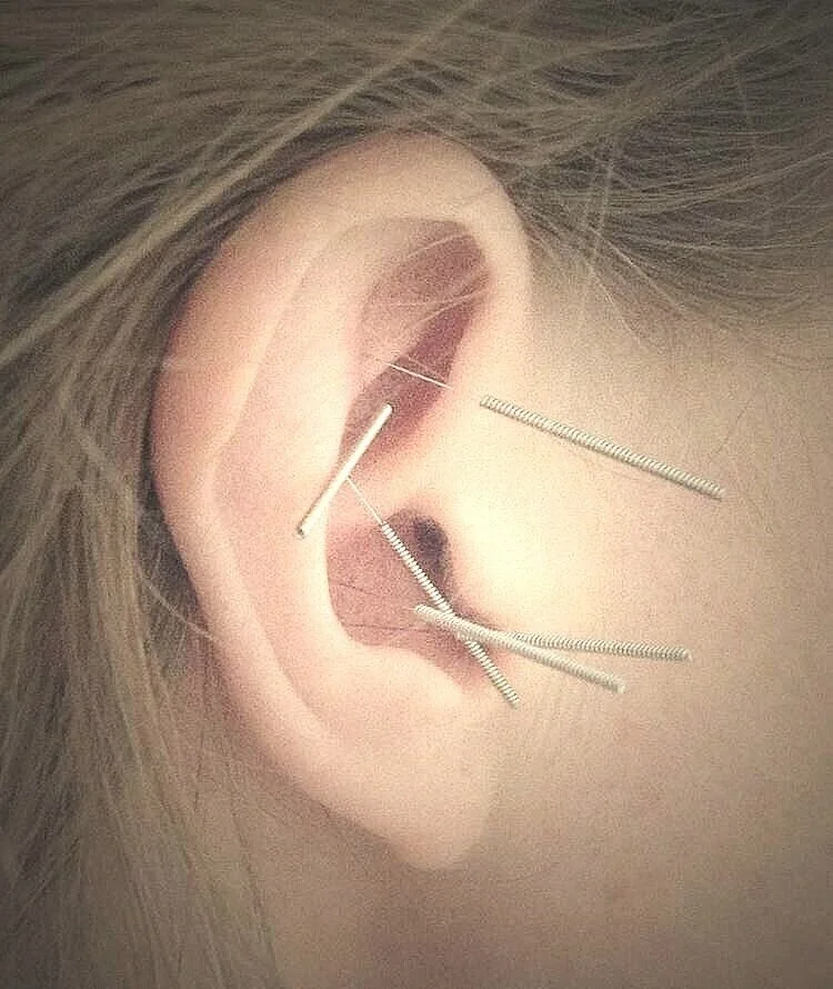 The NADA Protocol — Dr. Stephanie Cordes, ND