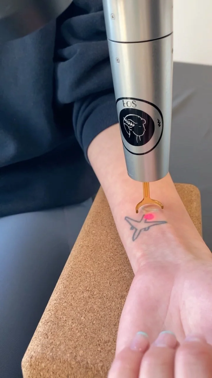EOS Tattoo Removal