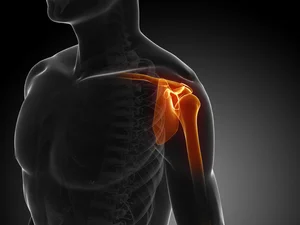 What is shoulder impingement and how can physical therapy help ...