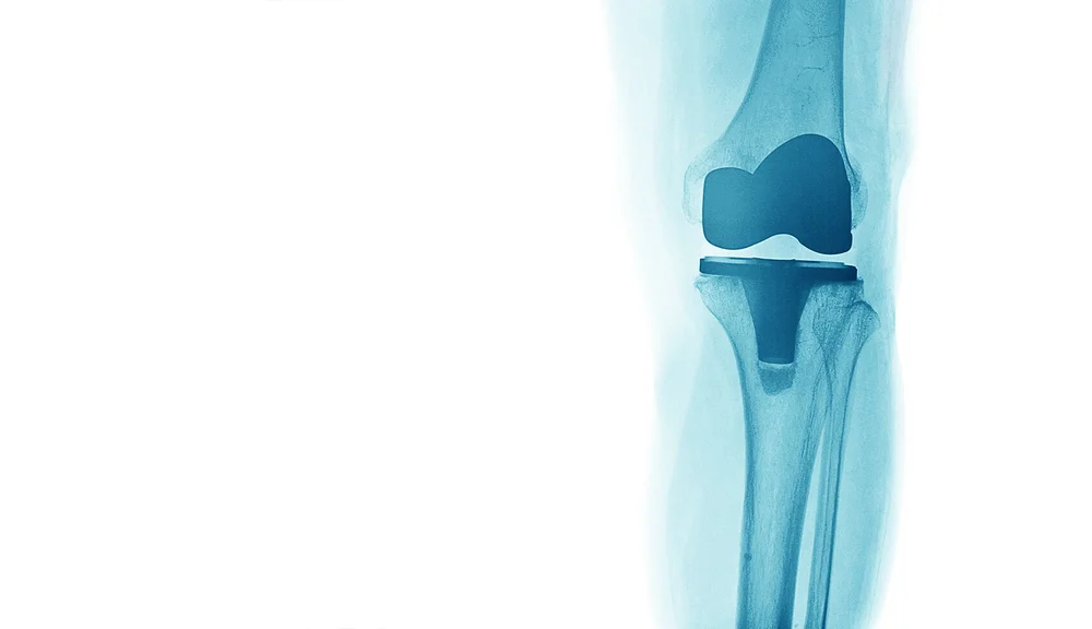 5 Signs You Need a Knee Replacement Surgery