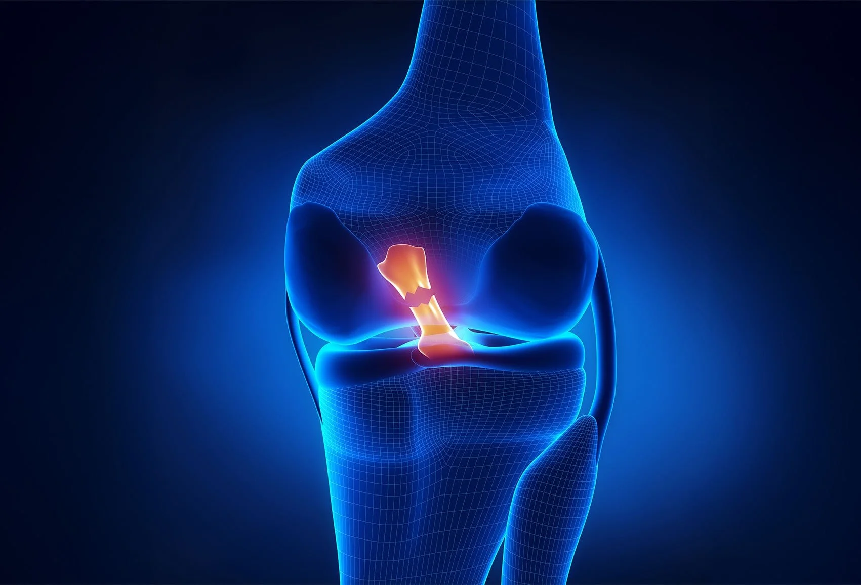 ACL Reconstruction Surgery Melbourne - Dr. David Sime
