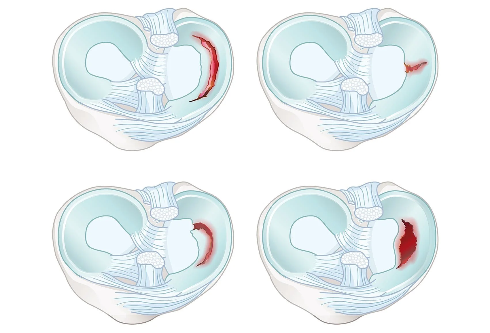 Meniscus Repair Melbourne | Dr. David Sime