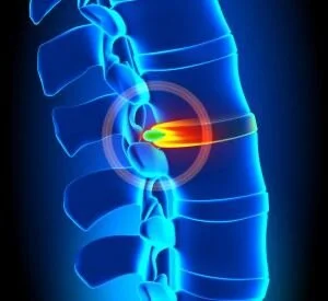 Spinal Decompression Therapy — Buckeye Physical Medicine & Rehab