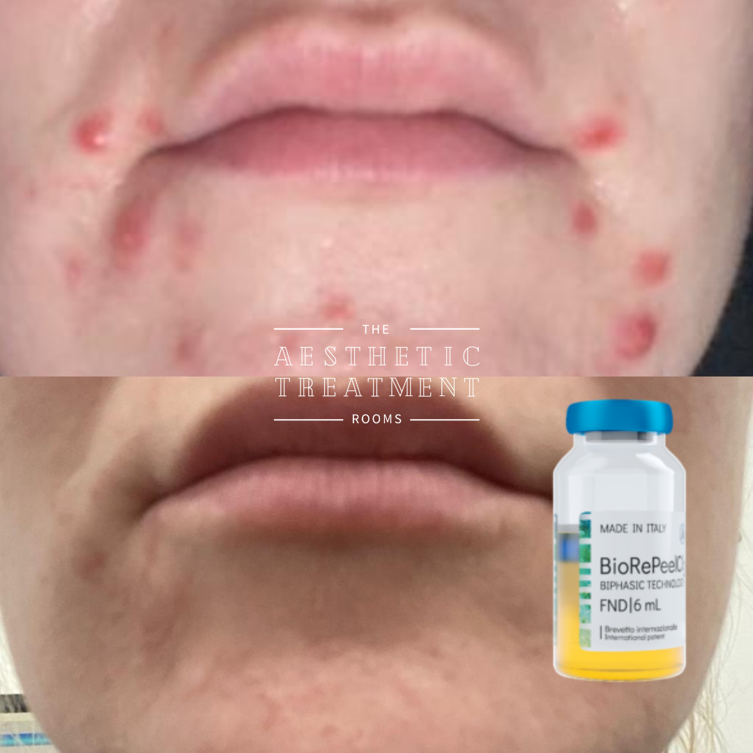 Chemical Peel | BioRePeel | Chemical Peel suitable for all skin | Benton