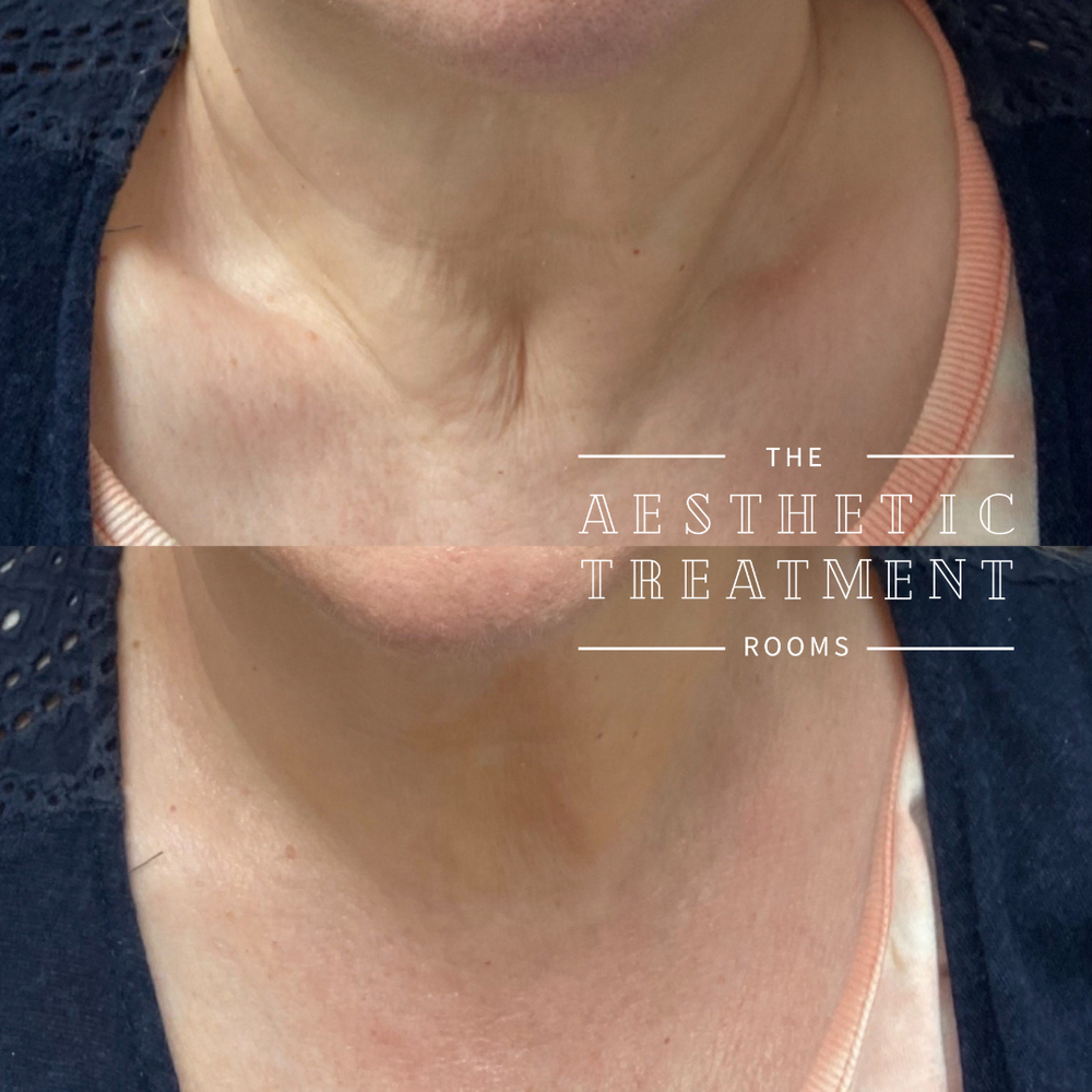 Before/After treatments — The Aesthetic Treatment Rooms
