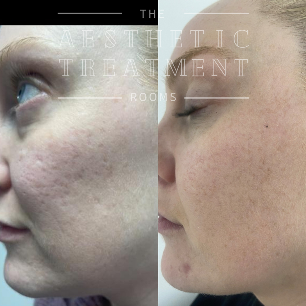 Mesotherapy | Karisma | Collagen