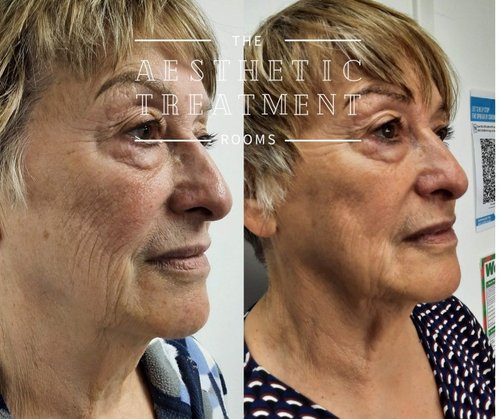 Mesotherapy | Karisma | Collagen