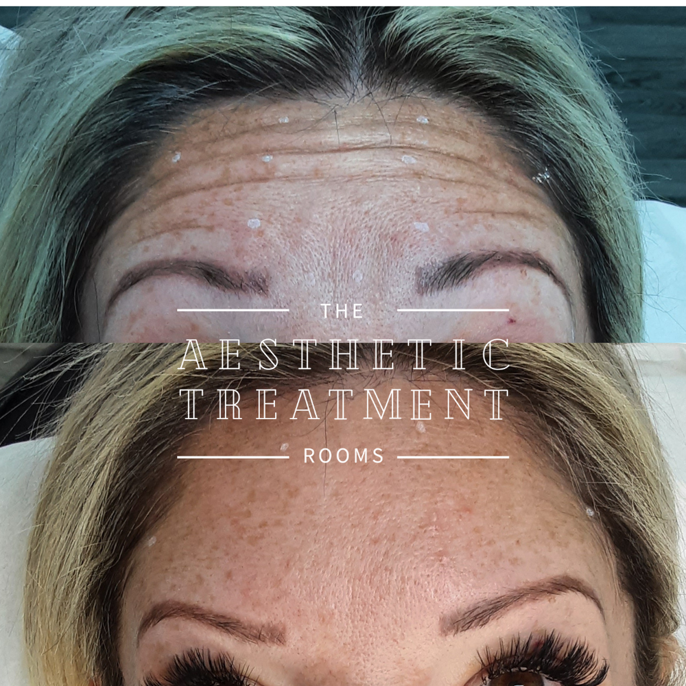 Before/After treatments