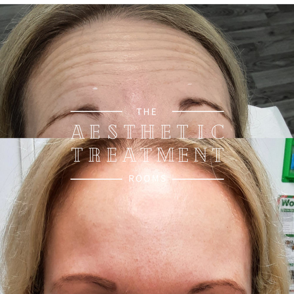 Before/After treatments