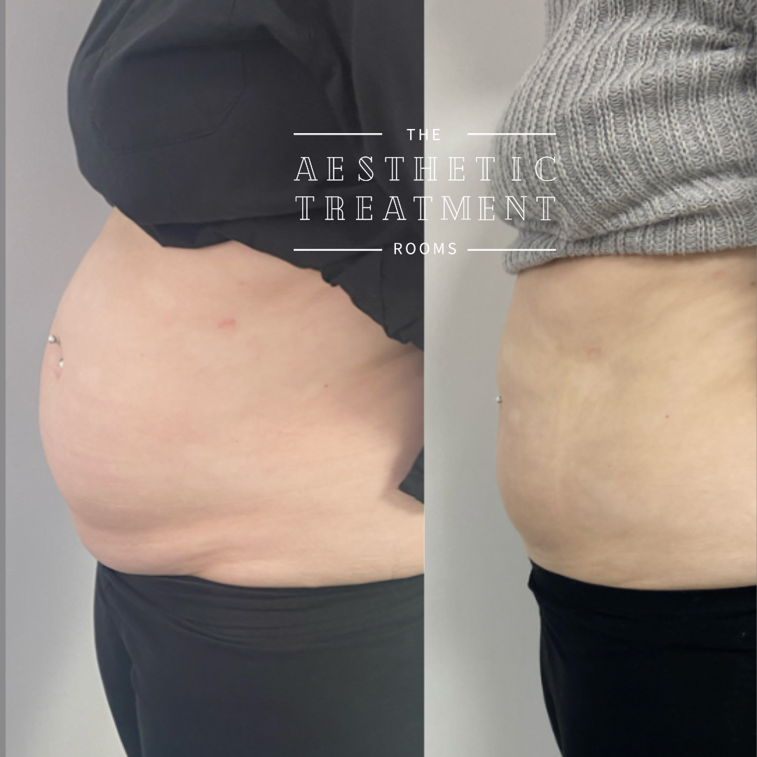 Effective Cellulite and Stubborn Fat Reduction at Aesthetic Treatment Rooms