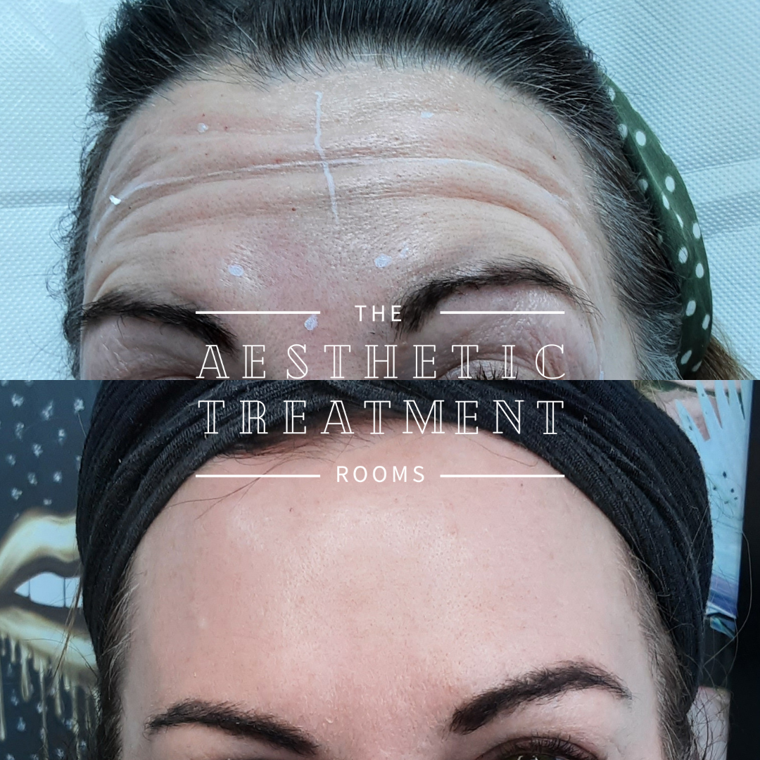 Before/After treatments