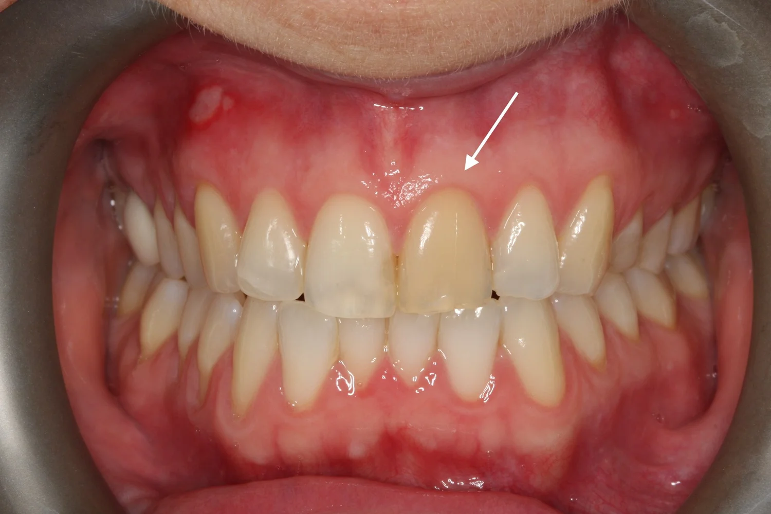 What a Dead Tooth Looks Like - Signs and Symptoms To Look Out For ...