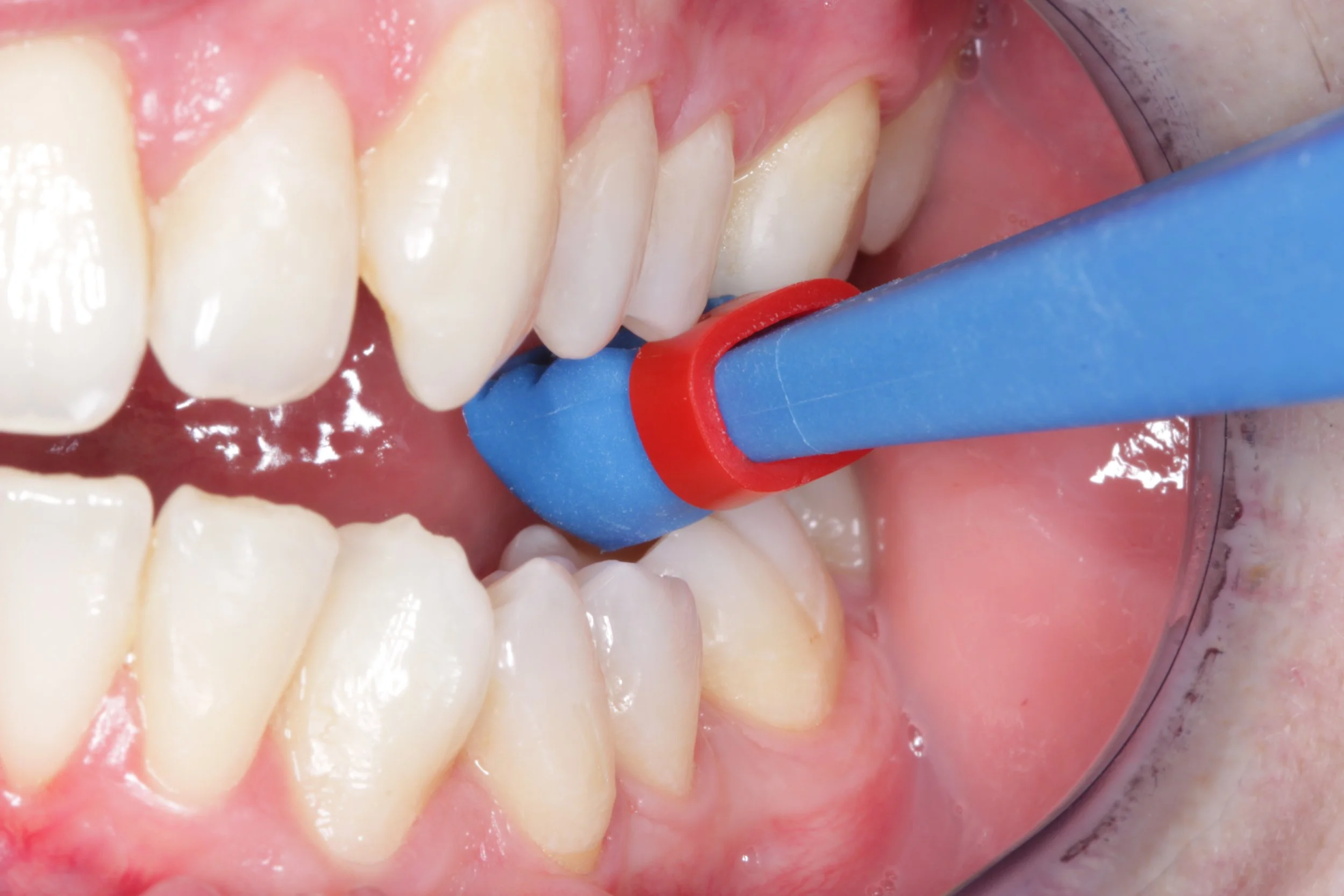 Cracked Tooth Syndrome (Fractured Tooth) - Everything You Need to Know ...