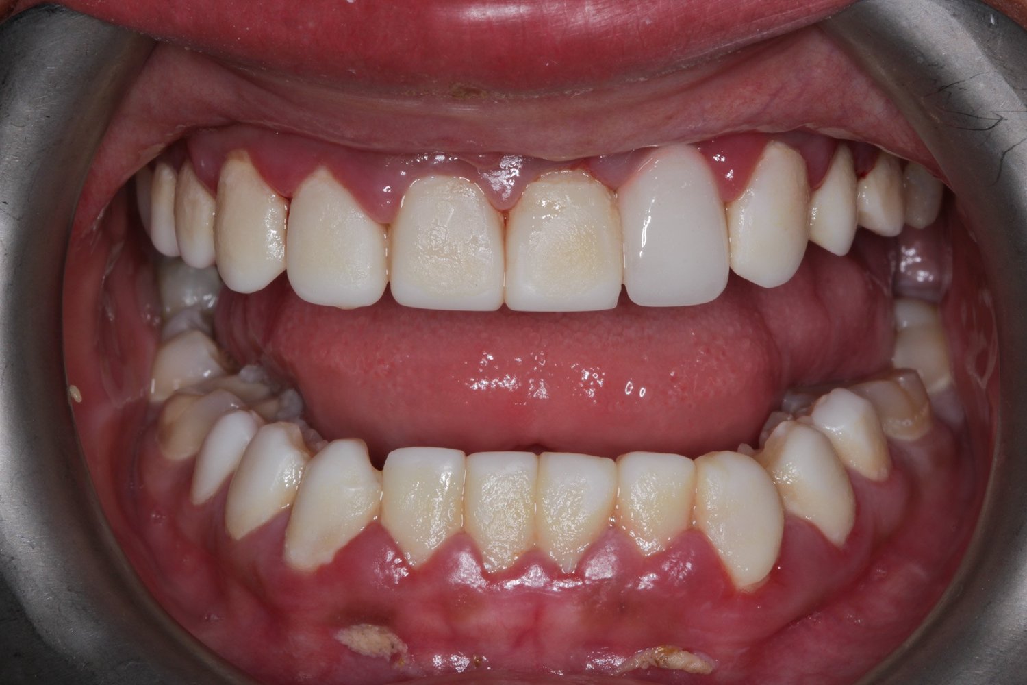 Bad Composite Bonding: A Comprehensive Guide on what to do next — Nova ...