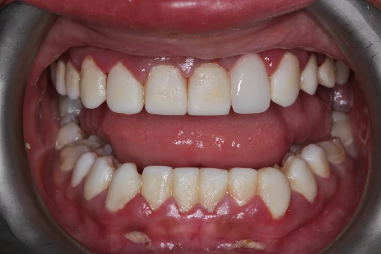 Bad Composite Bonding: A Comprehensive Guide on what to do next — Nova ...