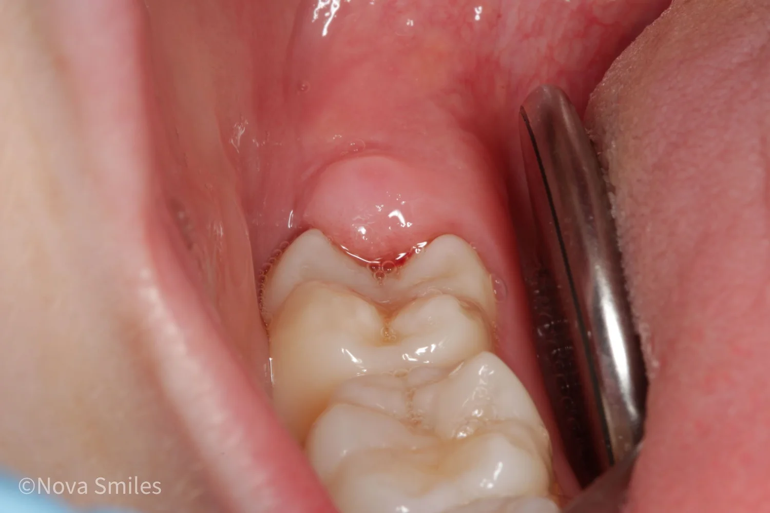 Pericoronitis (Wisdom tooth pain) — Nova Smiles