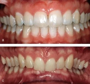 Restricted Envelope of Function (Deep Bite) — Nova Smiles