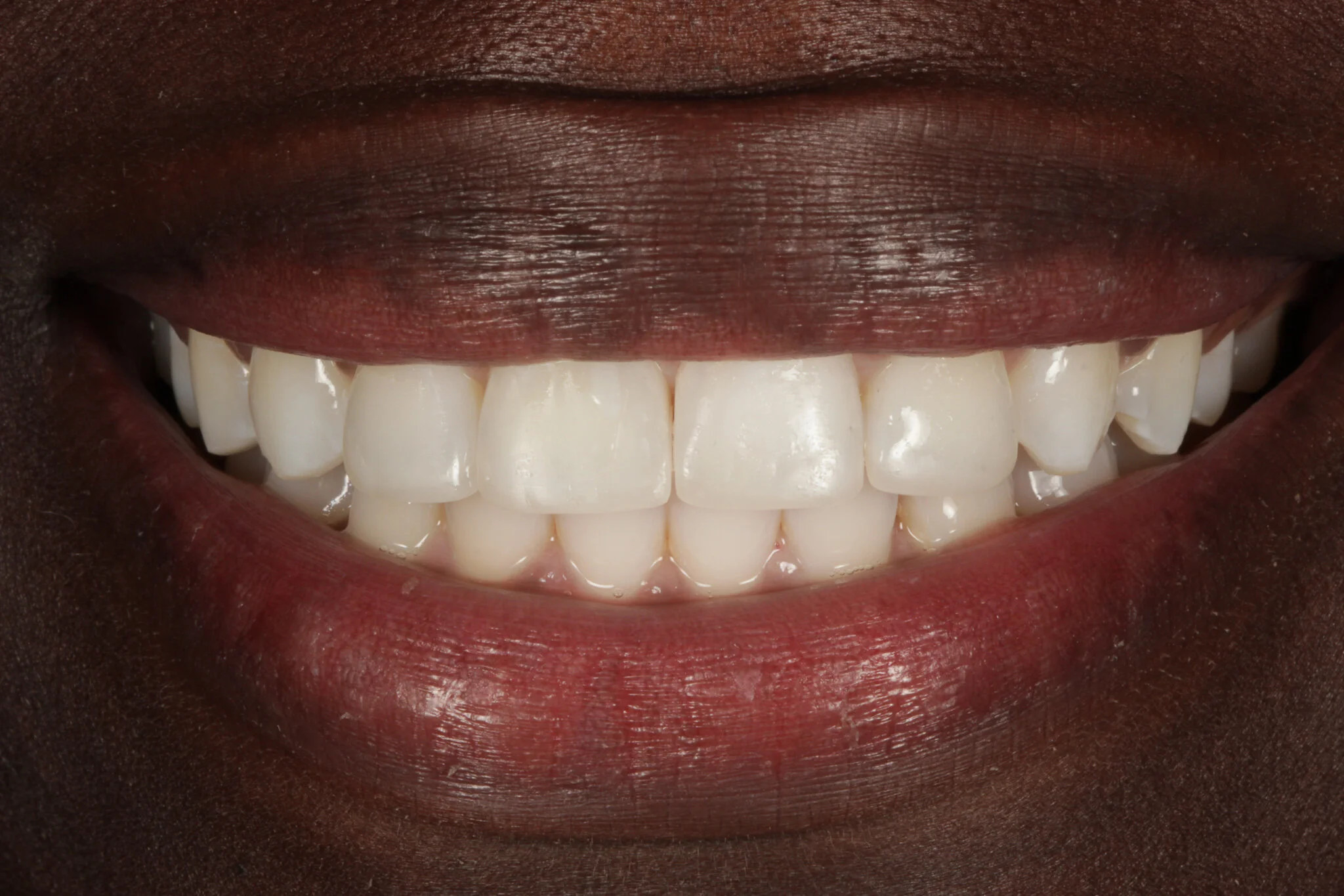 Composite Bonding | Enhance Your Smile Today — Nova Smiles