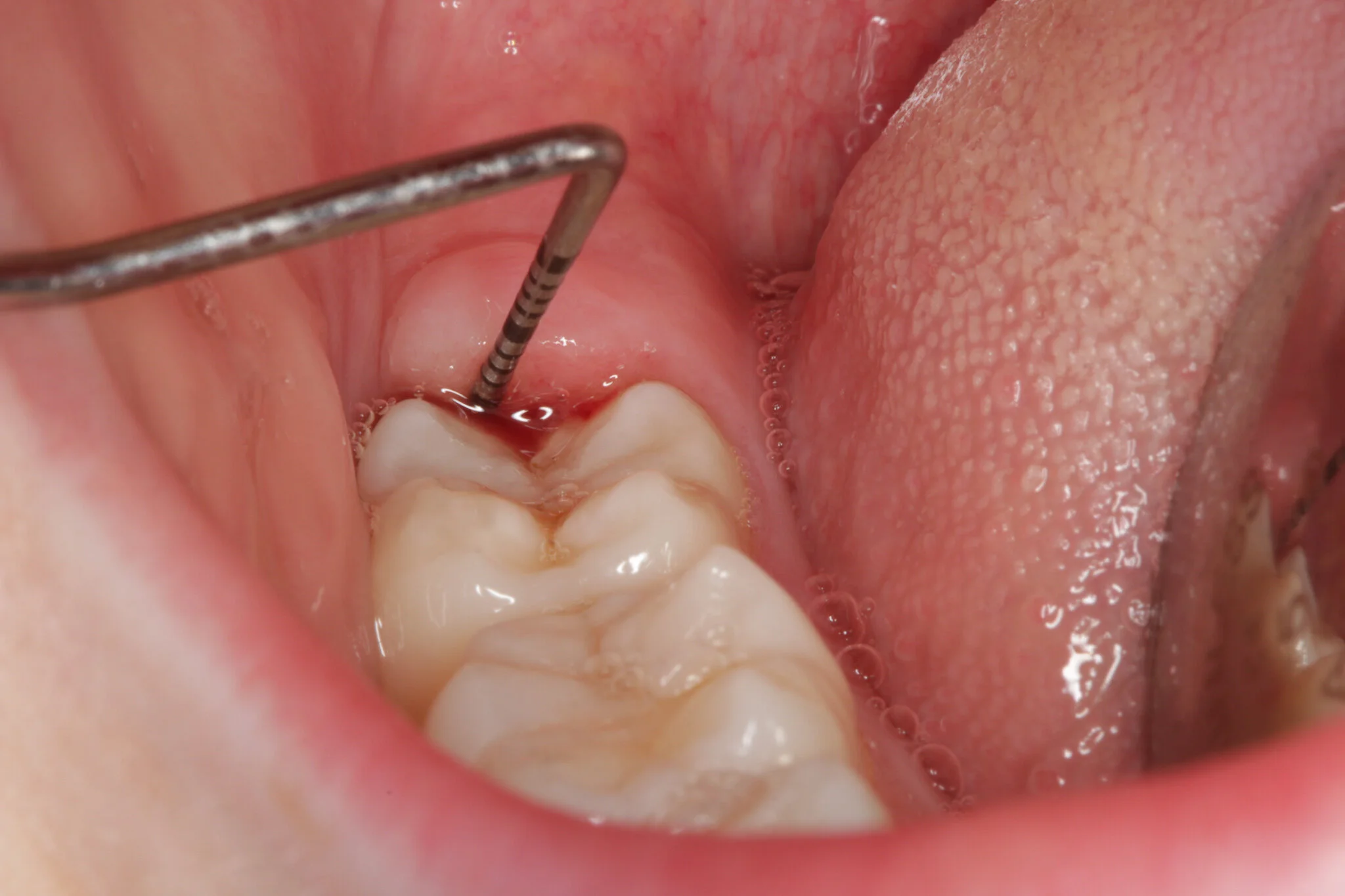 Severe Pericoronitis