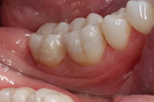 Dental Onlays - Everything You Need To Know About Them — Nova Smiles