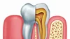 Root Canal Fillings - Everything you need to know — Nova Smiles