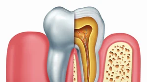 Root Canal Fillings - Everything you need to know — Nova Smiles