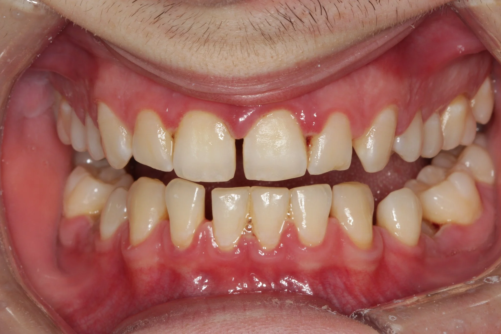 Acute Necrotising Ulcerative Gingivitis (ANUG) - Everything You Need to ...