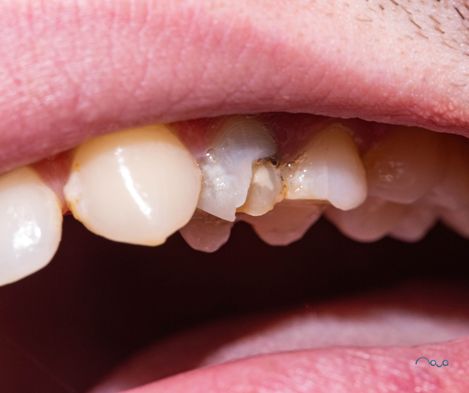 Causes of Tooth Discoloration: Common Reasons and Prevention Tips ...