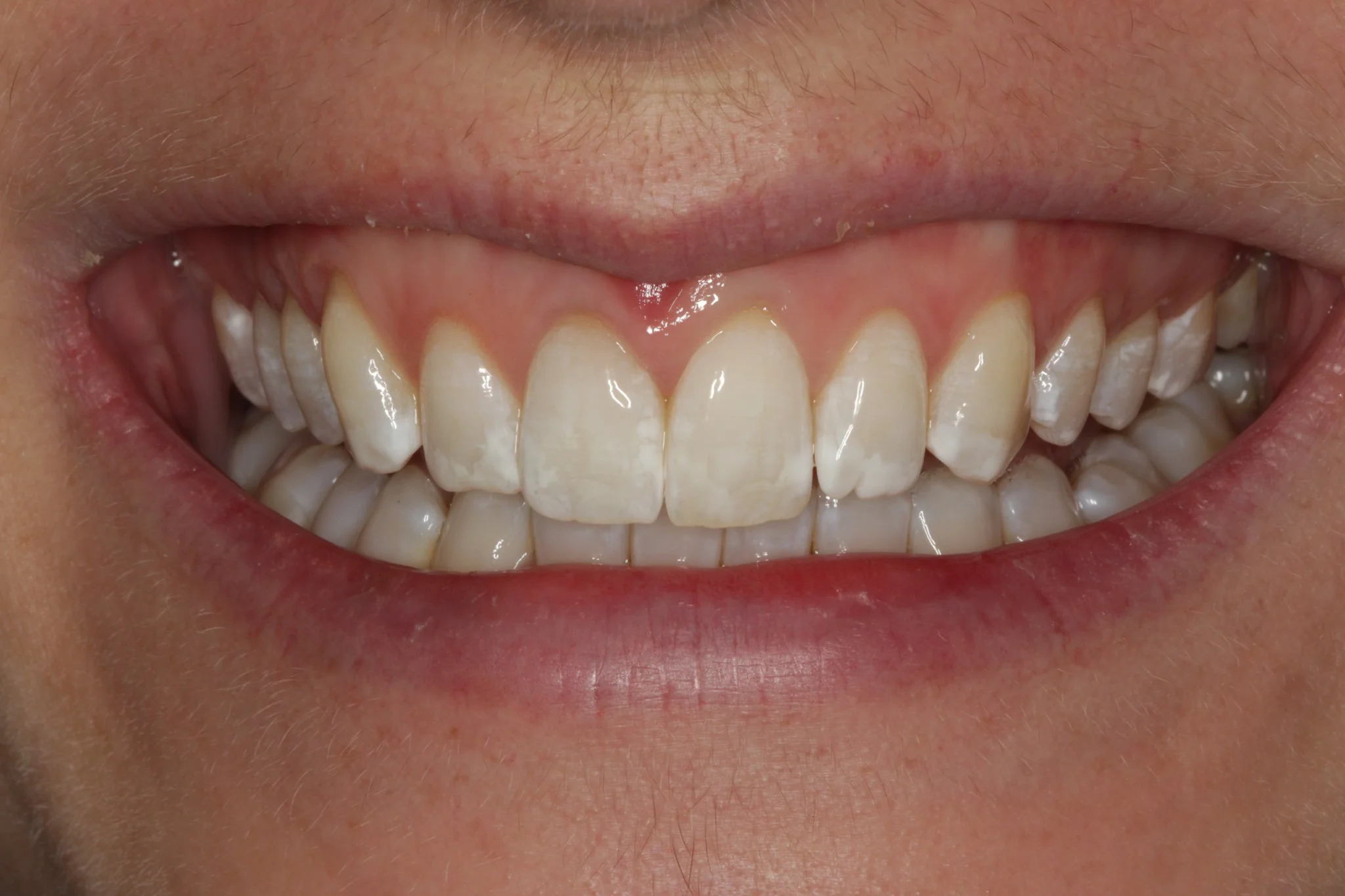 Single dark tooth (dead tooth) — Nova Smiles