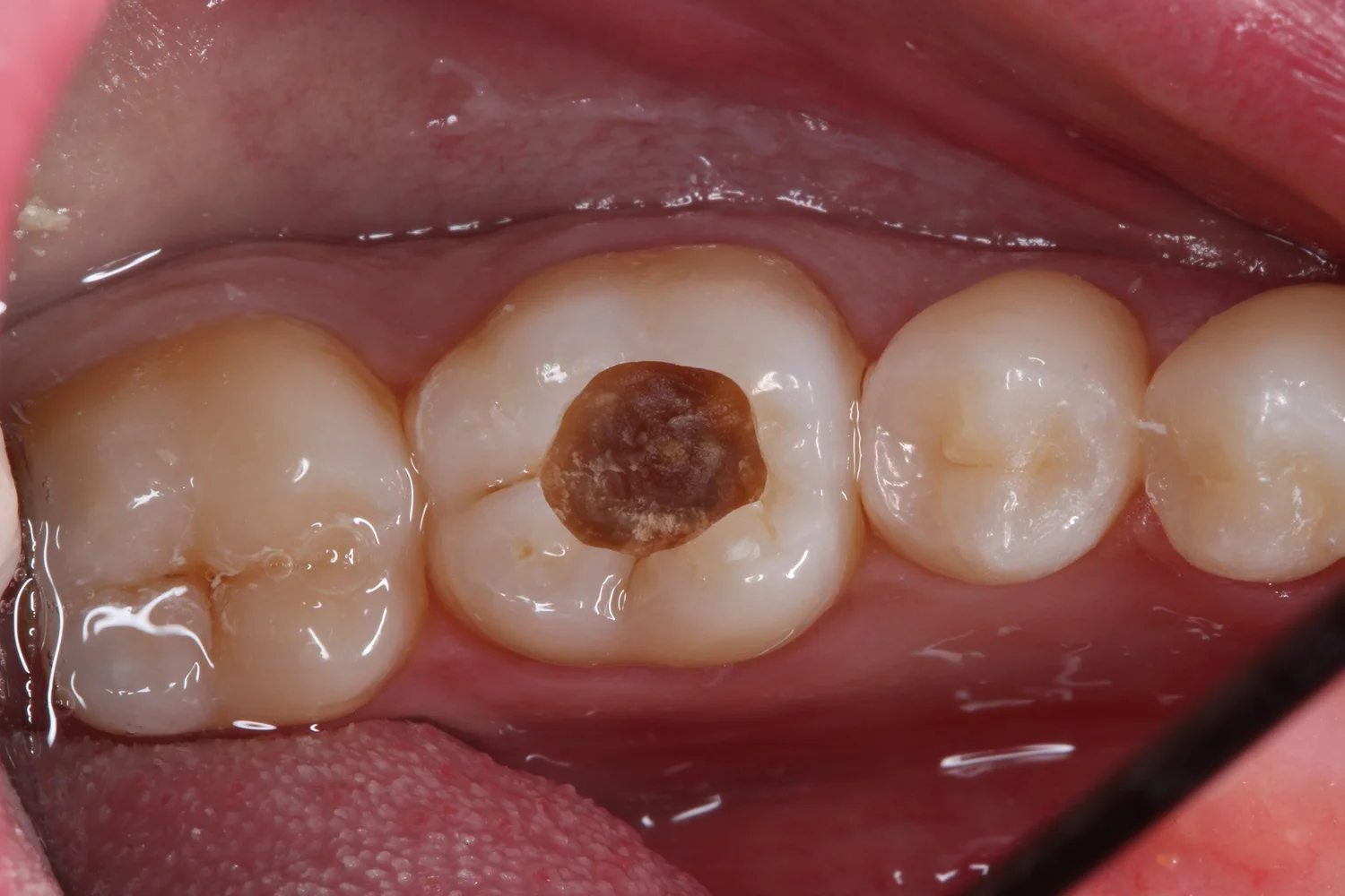 Do You Need a Dental Filling If You’re Not in Pain? Here's Why It's ...