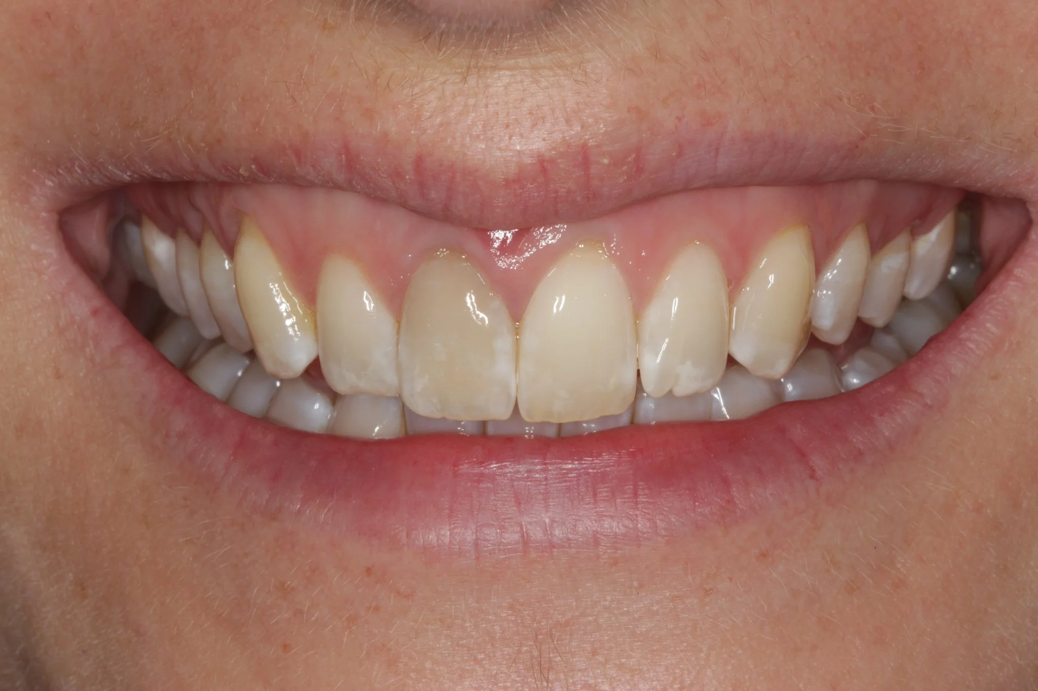 Single dark tooth (dead tooth) — Nova Smiles