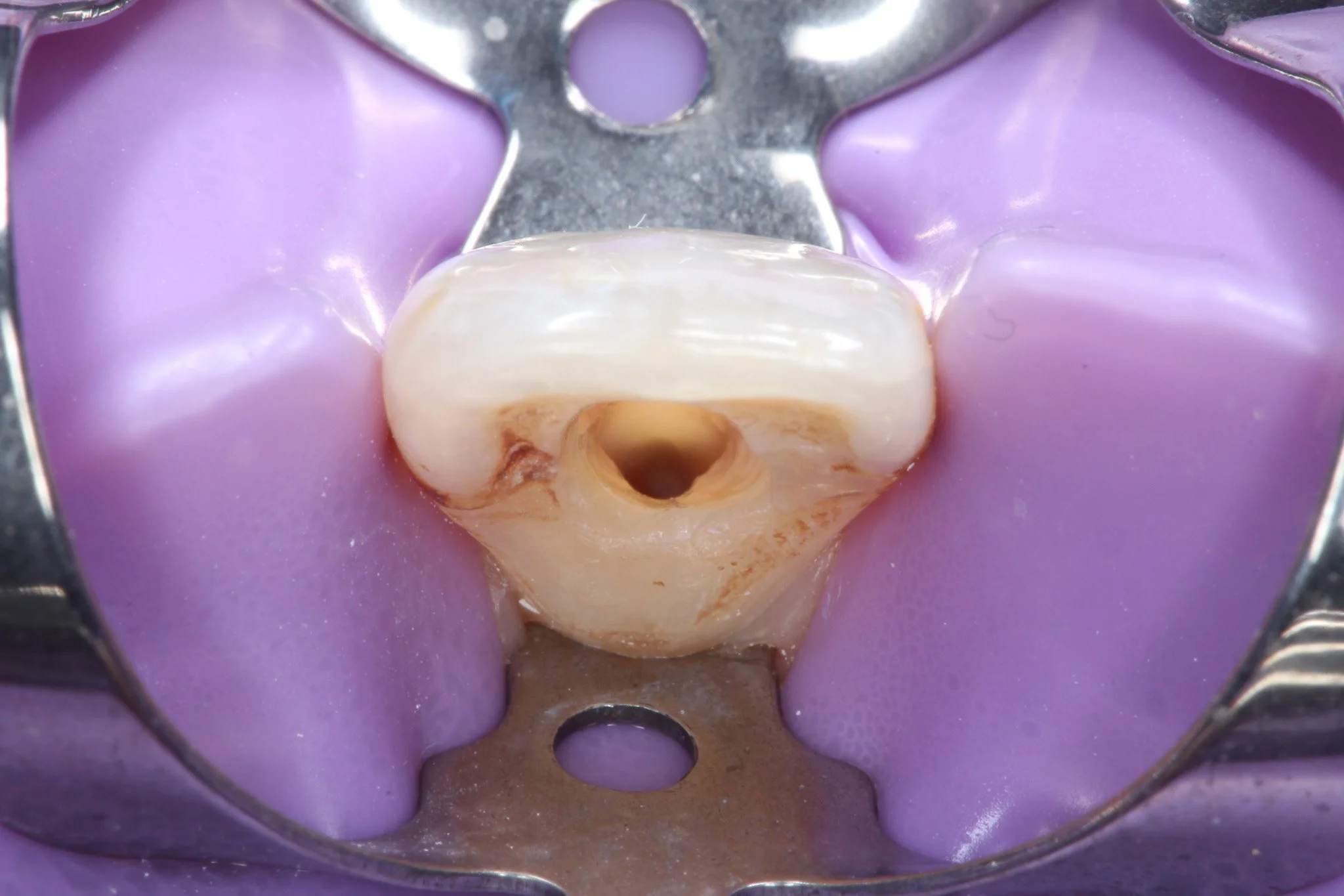 Pulp Extirpation Explained: Pain Relief and Root Canal First Step ...