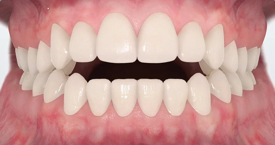 B Splints - Everything you need to know — Nova Smiles