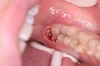 Operculectomy Treatment For Wisdom Teeth - Everything you need to know ...